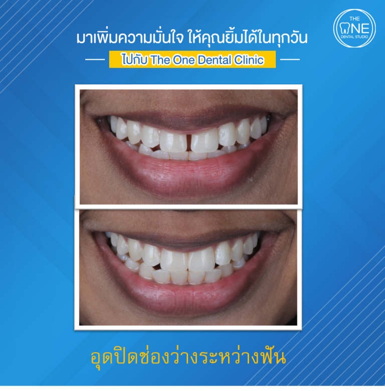 Result - คลินิกทันตกรรม The One Dental Studio
