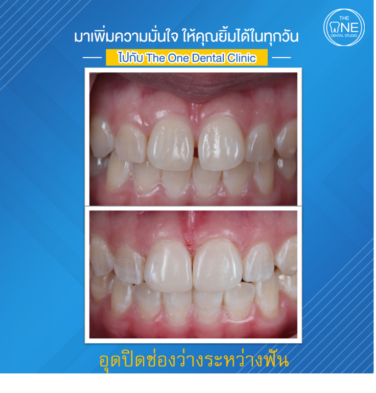 Result - คลินิกทันตกรรม The One Dental Studio